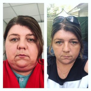 Lihavuusleikkaus (mahalaukun ohitusleikkaus) Virossa | Medimatkat